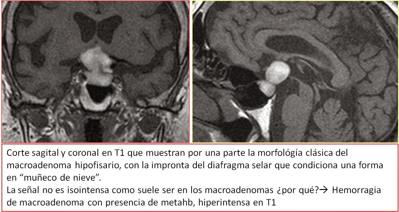 ESPE 203-2013: Patología de región selar: rol de imagenología