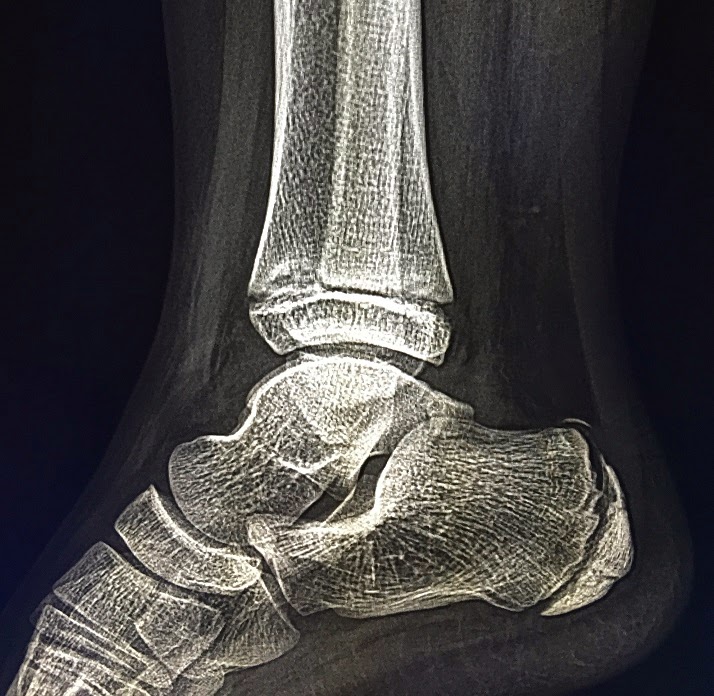 Ortopedia Pediátrica: Femenino de 9 años de edad con diagnóstico de ...