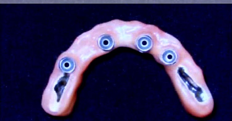 PRÓTESE DENTAL: Prótese Protocolo Imediata Inferior - Odonto-Tv