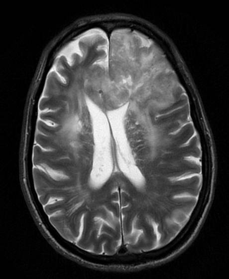 Multiple Sclerosis Research: Espresso clinical tutorial (1): Fulminant ...