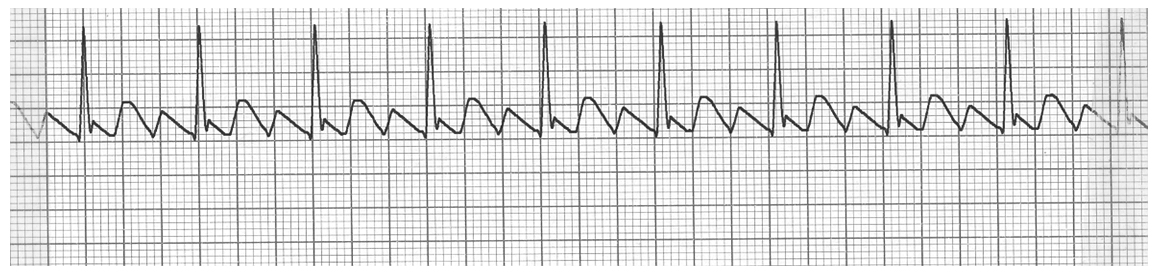 Pediatrics Notes: Introduction to Atrial Flutter in Children