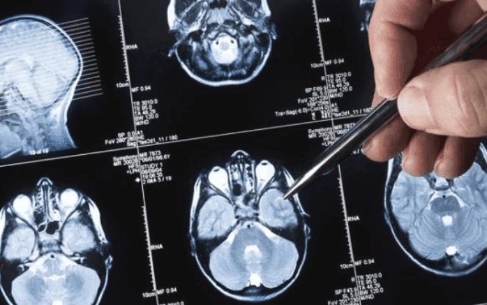 Surgeons Used To Split Brains For Epilepsy Treatment, And Here's Why ...