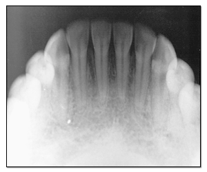 Dentistry and Medicine: Intraoral Radiographic Techniques (Intraoral ...