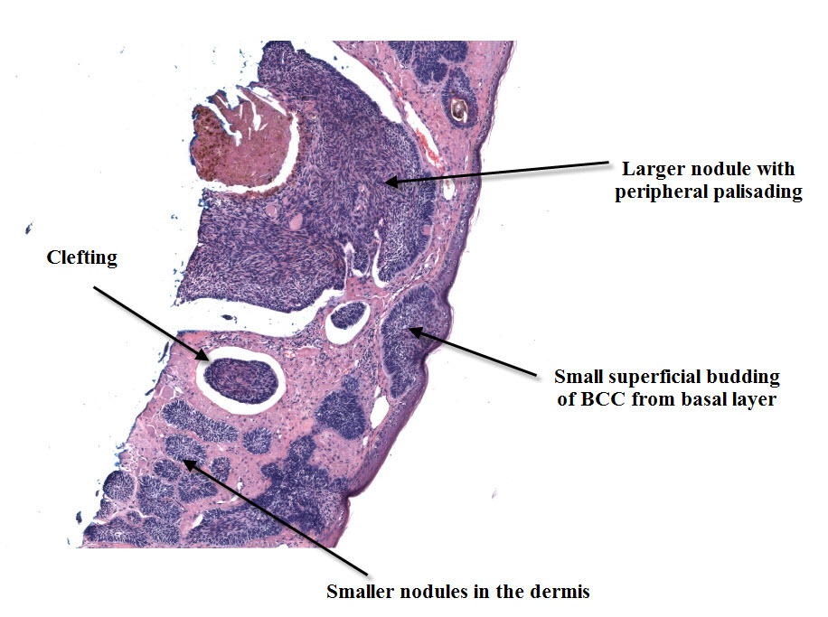 Dermpath Made Simple - Neoplastic: Basal Cell Carcinoma