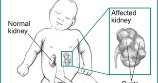 Birth defects Kidney 1