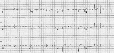 ECG of the Week: ECG of the Week - 4th March 2013 - Interpretation