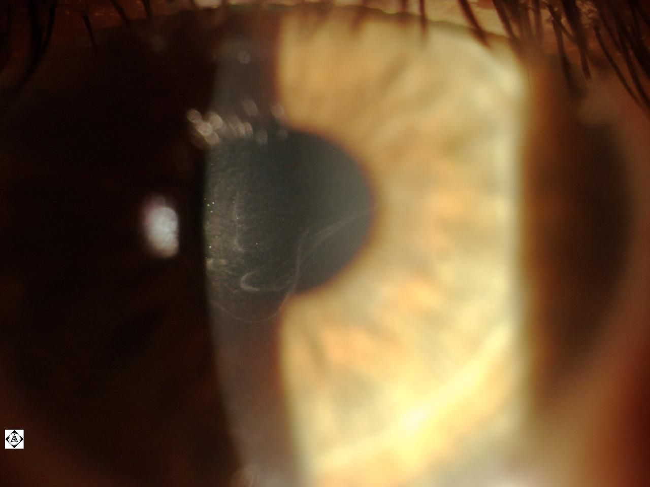Sonoran Desert Eye Center: ANTERIOR CORNEAL BASEMENT MEMBRANE DYSTROPHY
