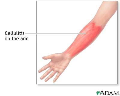 Family Chiropractic's Wellness: Cellulitis and Diabetes