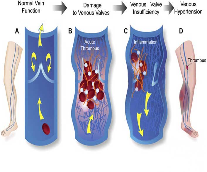 Prostate Enlargment Treatment without Surgery: Varicose Vein Stripping ...