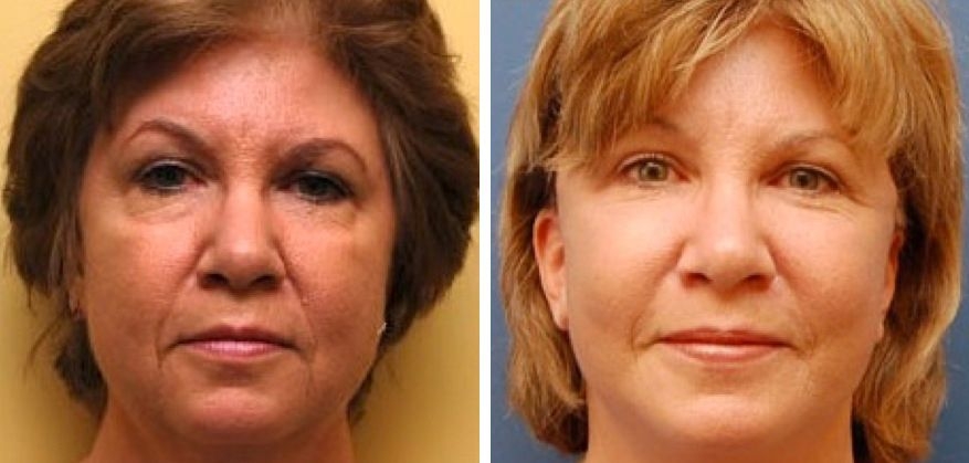 DIY Non-Invasive Facelift With Face Toning Exercises