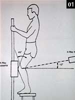 Radiologia para Técnicos: Radiografia do joelho ortostática