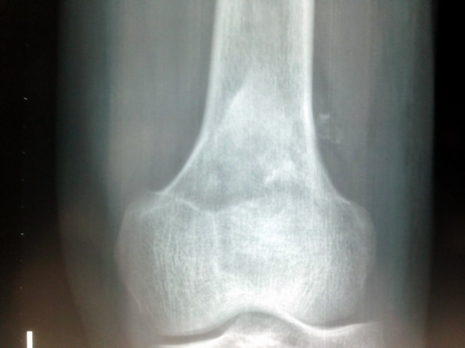 VIETNAMESE MEDIC ULTRASOUND: CASE 277: CLOSE BY KNEE JOINT TUMOR, Dr ...