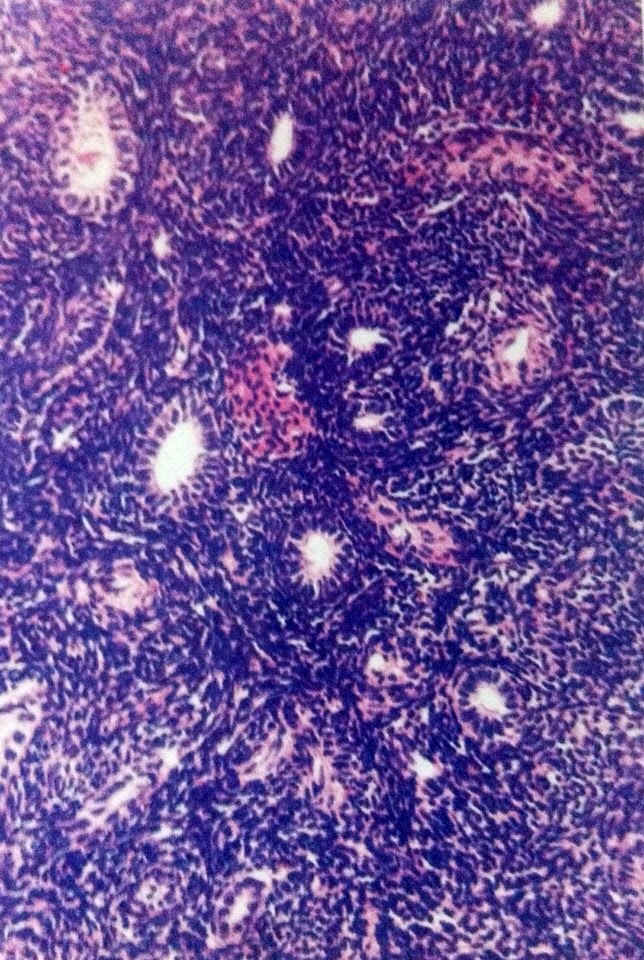 Pathology: ENDOMETRİAL POLYPS