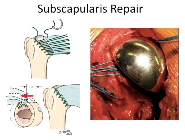 UW Shoulder and Elbow Academy: Shoulder joint replacement step by step ...