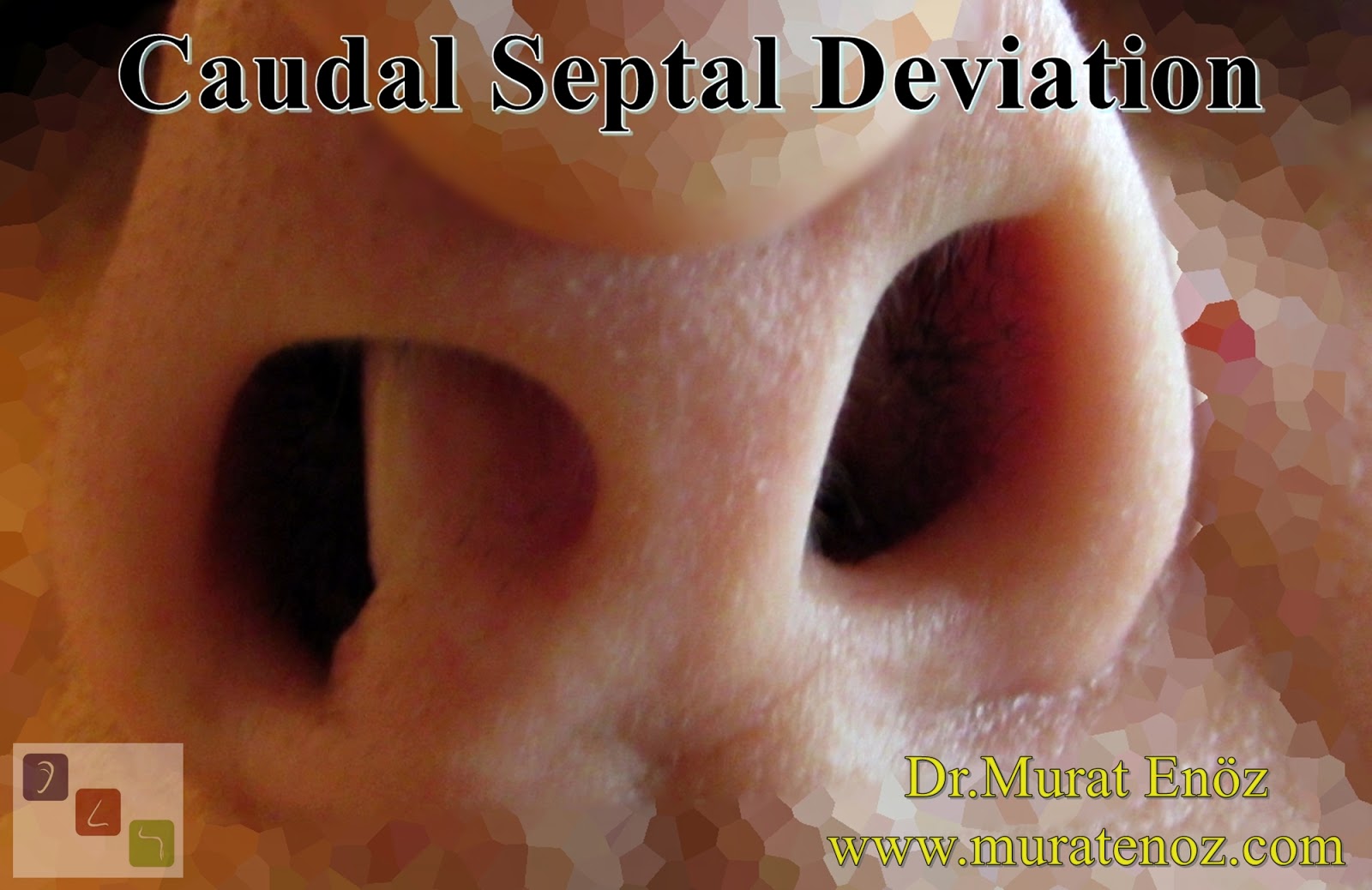 Correcting The Deviated Septum