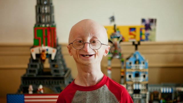 ENFERMEDADES RARAS: Progeria o síndrome de Hutchinson-Gilford ENFERMEDADES RARAS: Progeria o síndrome de Hutchinson-Gilford