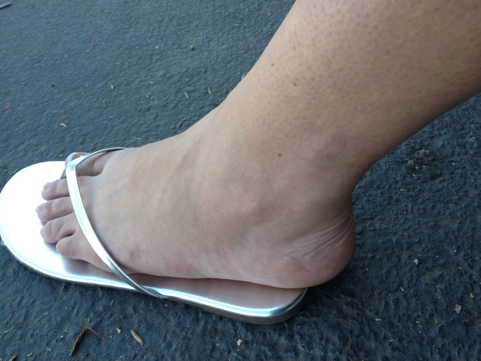 Life with Lupus: Swelling.....should I worry?