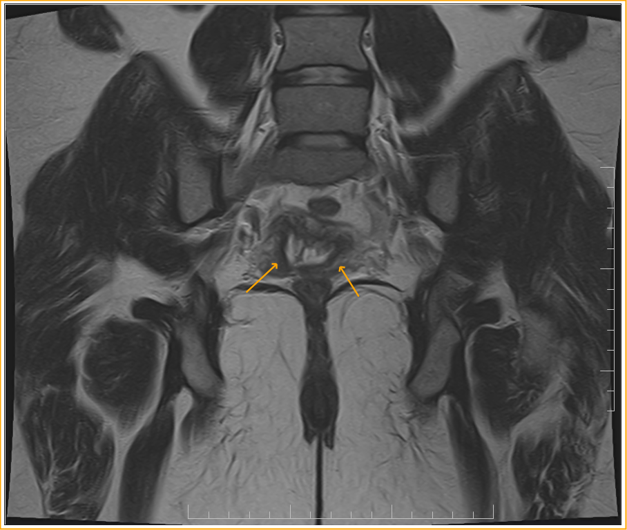 Bicornuate Uterus: MRI - Sumer's Radiology Blog
