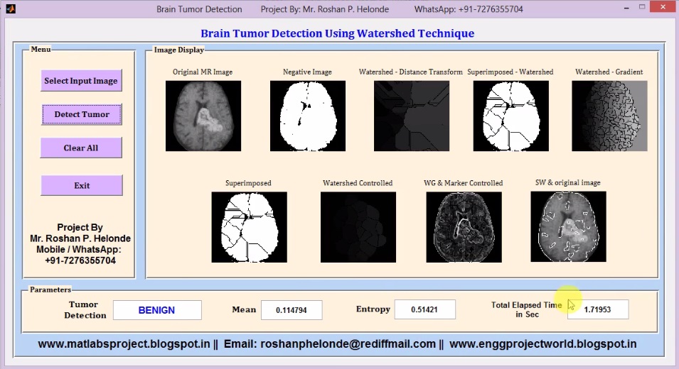 Brain Tumor Detection And Classification Using Watershed Technique Full