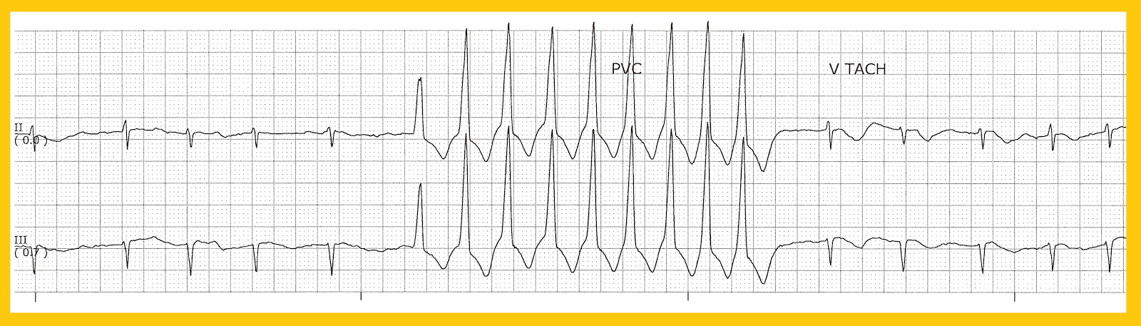 Practice Rhythm Strips 243
