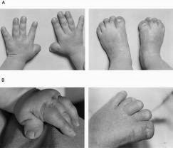 Medical Treatment Pictures-for Better Understanding: Achondroplasia ...