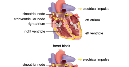 Heart block