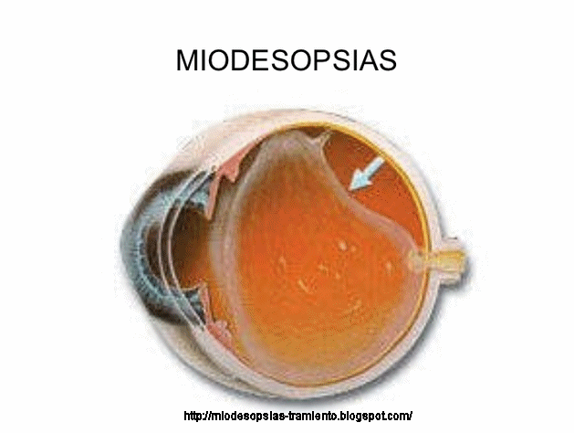 Que son las MIODESOPSIAS, Definición, Causas, Consecuencias ...