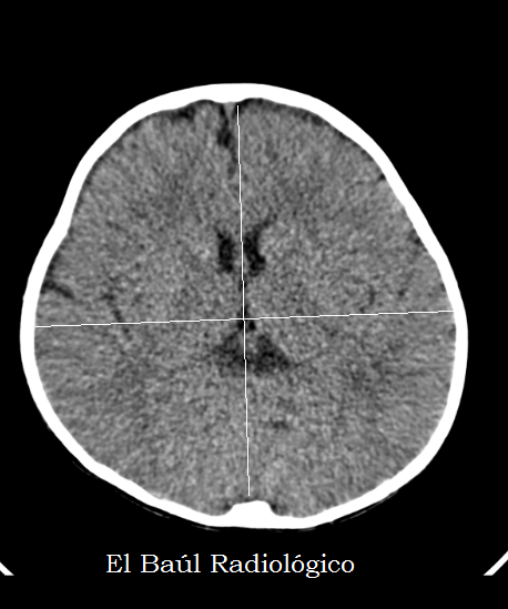 El Baúl Radiológico: CRANEOSINOSTOSIS. CIERRE PREMATURO DE LAS SUTURAS ...