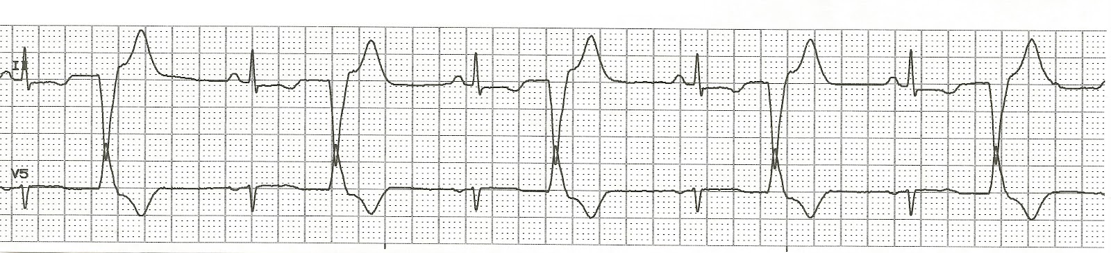 ECG Rhythm Strip Quiz 71