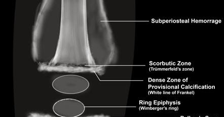 SIFAT's Disease ATLAS: Radiological findings of Scurvy ( vit C deficiency)