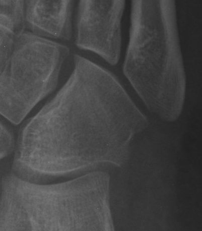 Daily Dose: cuboid fracture