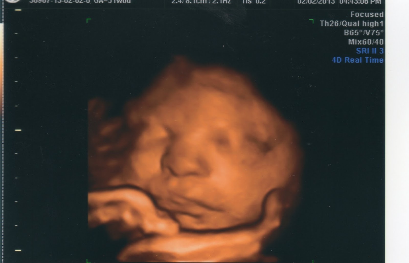 32 Weeks and 3D Ultrasound
