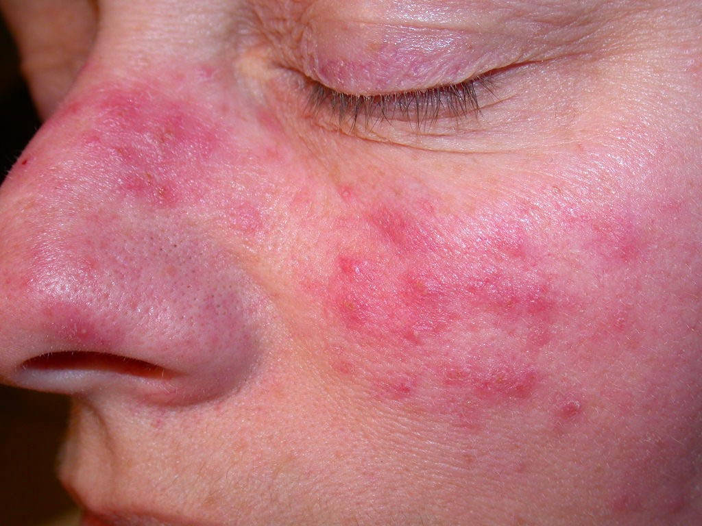 Rosácea e suas complicações, é possível trata-la? Em Mogi das Cruzes sim!!!