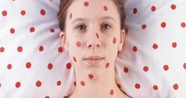 Morbillo, morbillosum, morbillotum, morbillantum... speriamo non moribondo