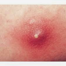 lactolite: Rawatan Sakit Bisul