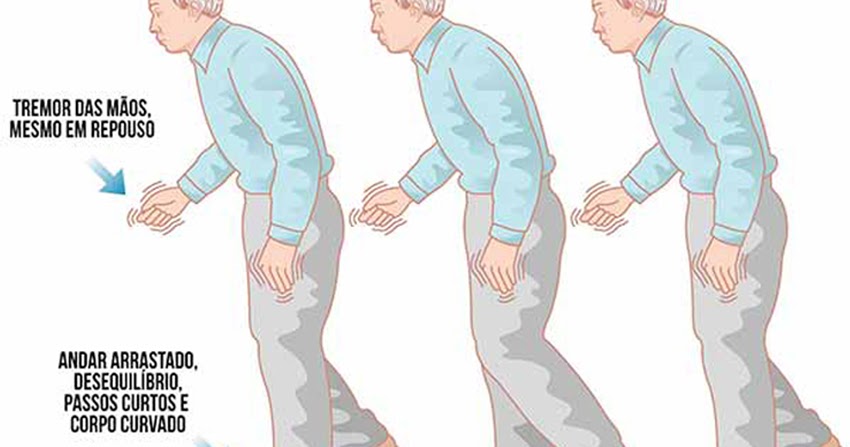 Dra. Geni Bernardino: Parkinson