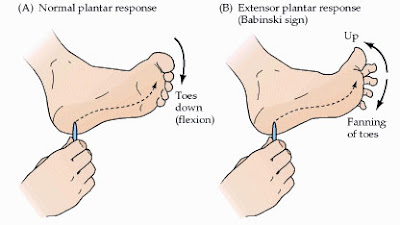 The plantar reflex - Babinski's sign