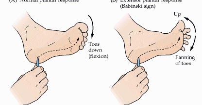 The plantar reflex - Babinski's sign ~ Medicine Hack