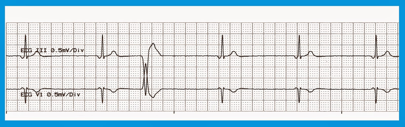 Practice EKG Strips 315