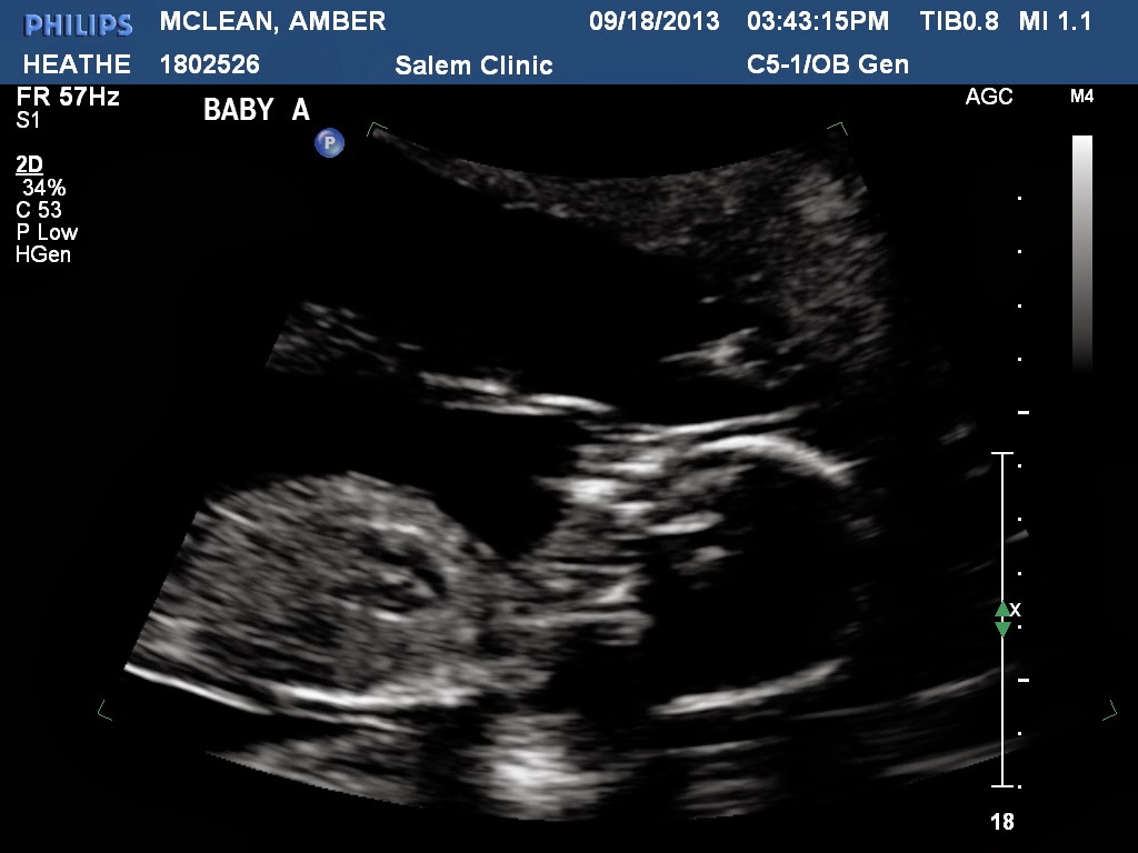 Old Lady and No Baby: 20 Week Anatomy Scan