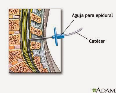 Anestesiología: Anestesia raquidea y epidural