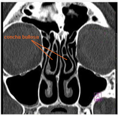 La Concha Bullosa ~ Forum institut-nez / Dr Gilles Ayoun