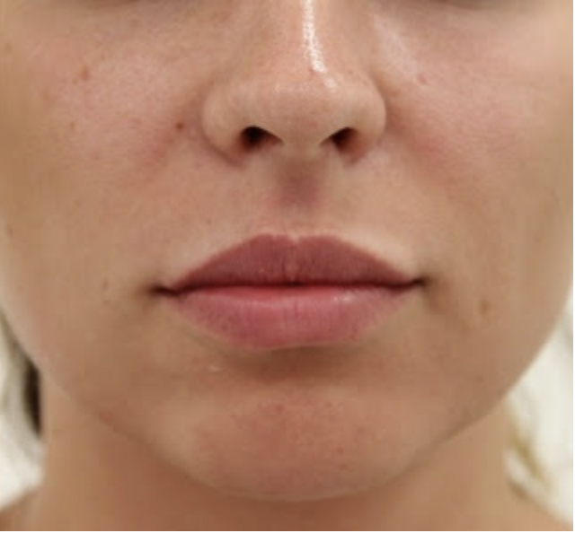 5 Reasons To Start Fillers in Your 40s - The Skin Radar