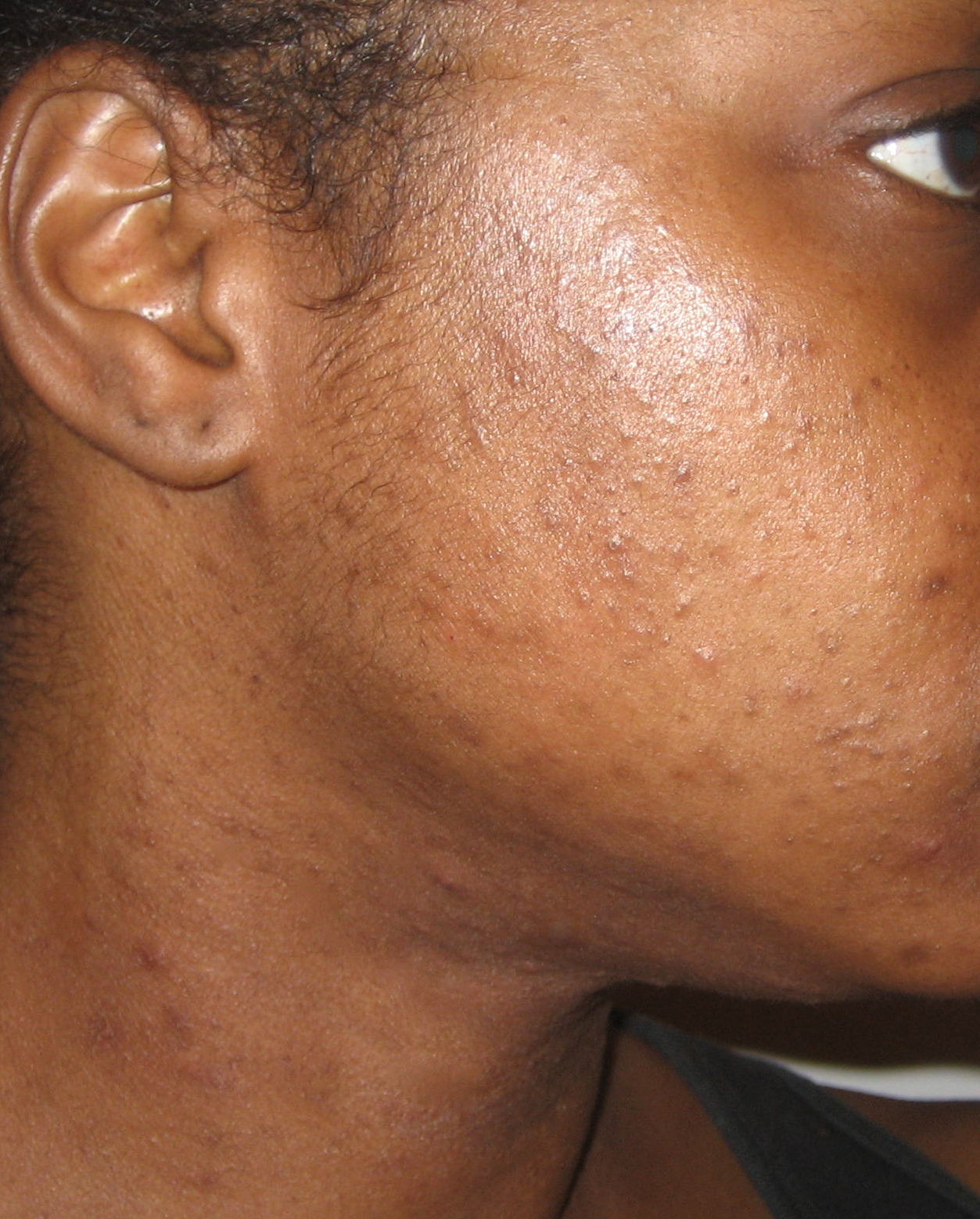 Steroid Rosacea