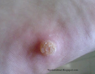 TipsInfoSihat - Maklumat Kesihatan Dan Penjagaan Diri: Fakta Ringkas ...