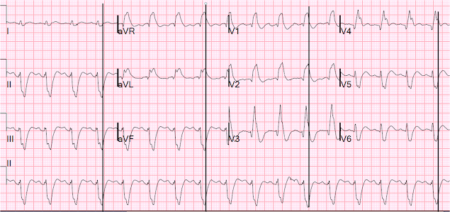 Dr. Smith's ECG Blog: 68 minutes with chest compressions, full recovery ...