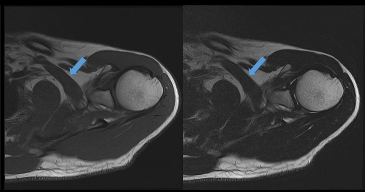 Ultimate Radiology : How strong is your 'Shoulder Anatomy'