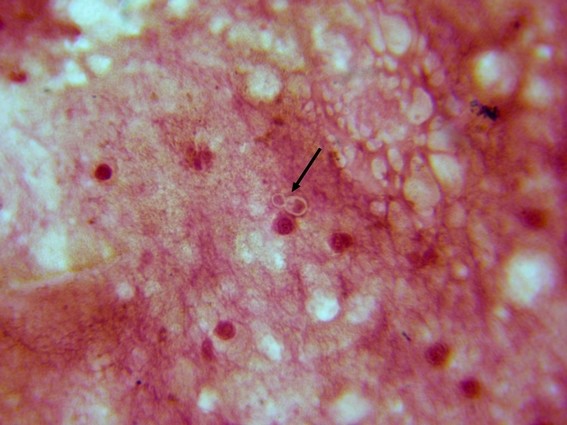 Fun With Microbiology (What's Buggin' You?): Blastomyces dermatitidis
