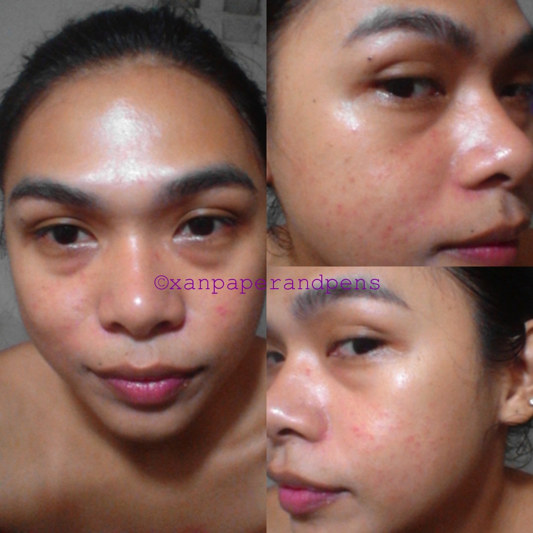 xanPaper and Pens: What is Acne Purging?