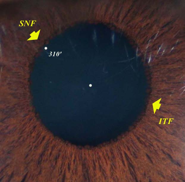 Modern & Multidimensional Iridology: Local Absent of IPB & Pupil ...